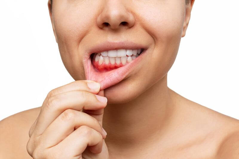 Ağız Boşluğu (Oral Kavite) Kanseri İçin Hangi Oranda Engelli Raporu ...